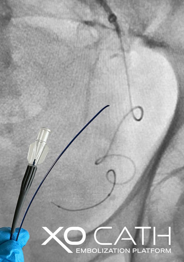 Transit Scientific Introduces XO Cath Embolic-Delivery Microcatheter ...