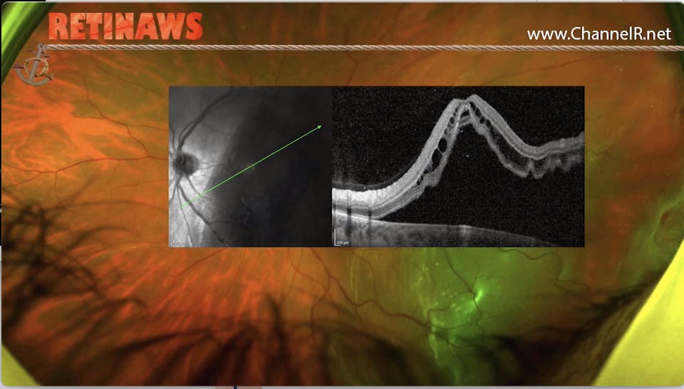 Maculoschisis - Eyetube