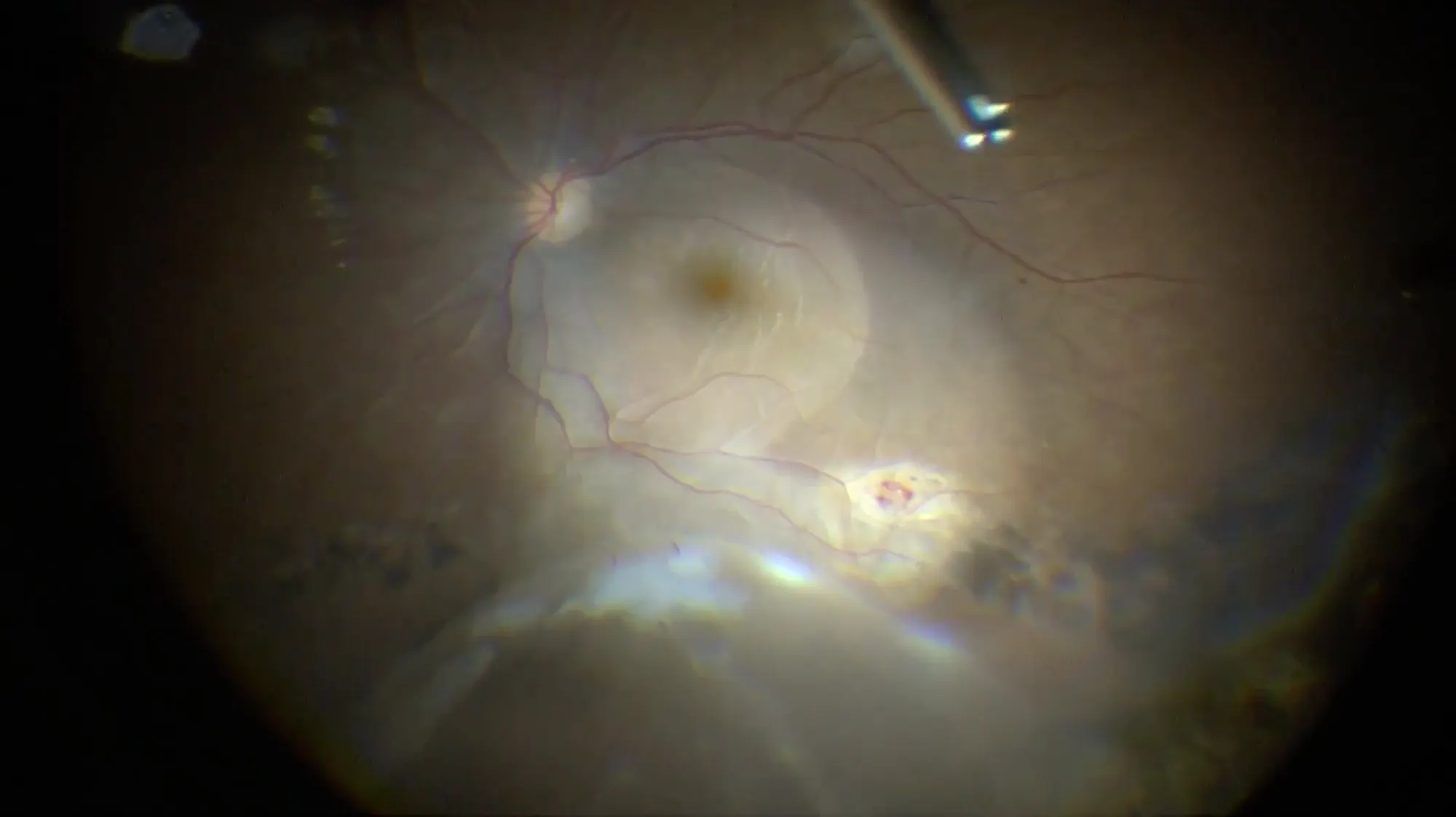 Retinoschisis Retinal Detachment - Eyetube