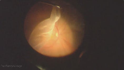 Giant Retinal Tear & Perfluoron - Eyetube